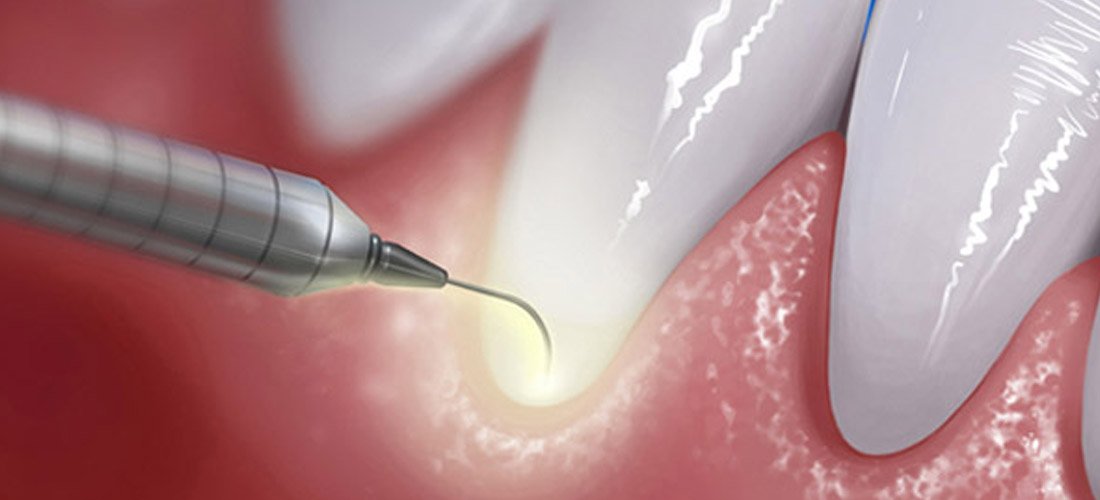 Laser parodontale | Studio Dentistico Dott.Calvi - Foligno