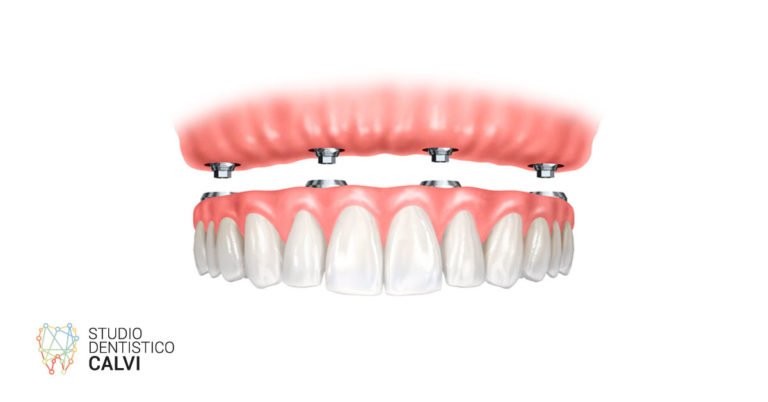 Protesi Toronto Bridge: che cos'è? | Studio Dentistico Calvi